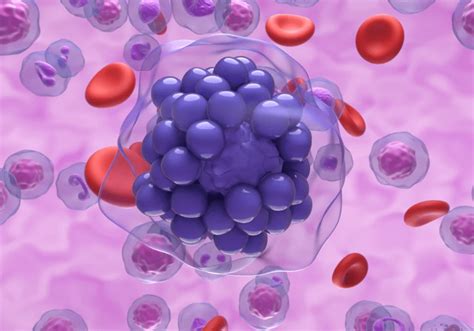 Advancing Prognosis In Diffuse Large B Cell Lymphoma