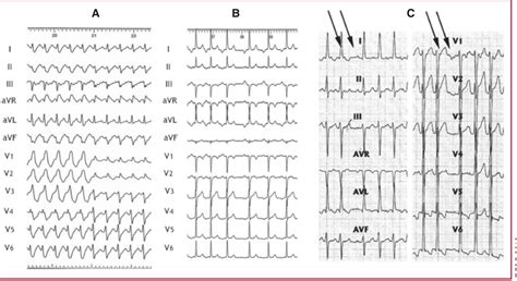 Focal Atrial Tachycardia A Focal Atrial Tachycardia