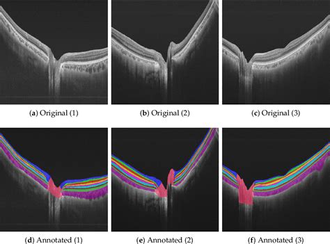 Figure 2 From Improving Oct Image Segmentation Of Retinal Layers By Utilizing A Machine Learning