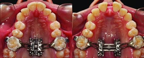 Occlusal Views Before And After Expansion With Marpe Download