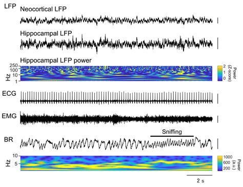 Simultaneous Recordings Of Cortical Local Field Potentials Electrocardiogram Electromyogram