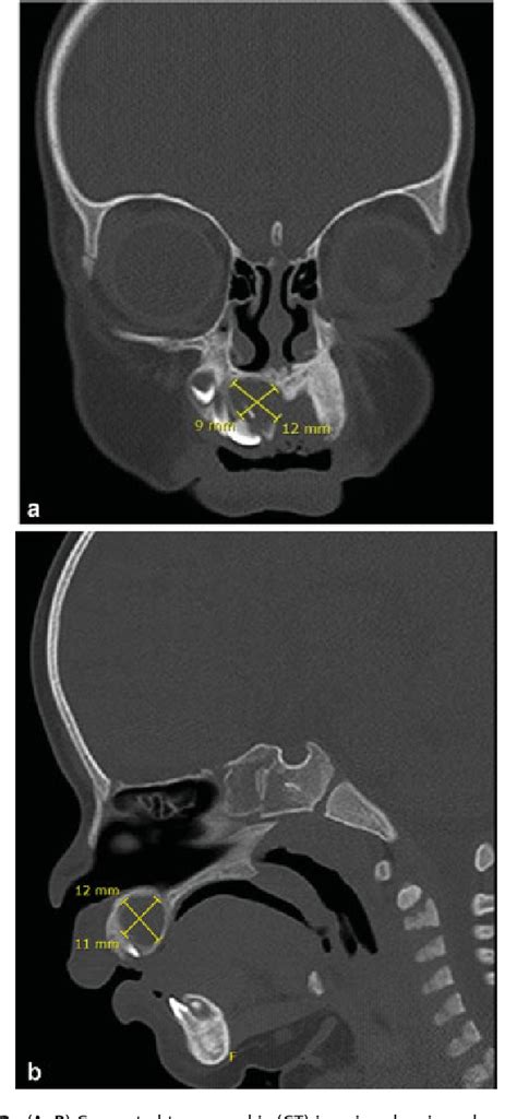 Figure 2 From Melanotic Neuroectodermal Tumor Of Infancy With A Negative Vma A Case Report And