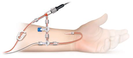 LiDCOplus LiDCO Hemodynamic Monitoring For The Entire Patient Pathway