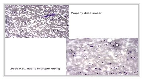 Bone Marrow Aspiration And Biopsy Pptx