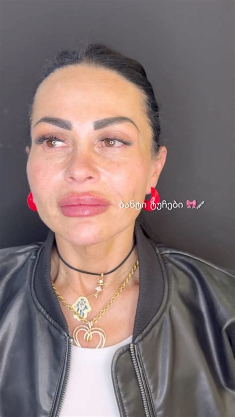 Aesthetic Doctor 💤😴საცრემლე ღარის ამოვსება 📌აღკვეთს დაღლილ შეხედულებას 📌არ საჭიროებს