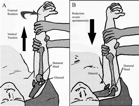 How To Reduce A Shoulder Dislocation Deepcontrol3