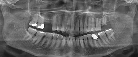 Osteoporosis X Ray Jaw