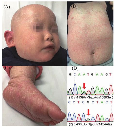 Congenital Ichthyosiform Erythroderma
