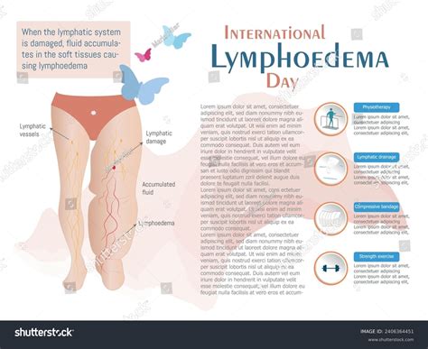 Leg Lymphedema Some Treatments Improvement Along Stock Vector Royalty
