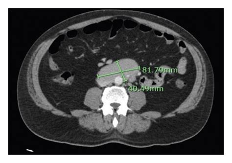 Ct Abdomen And Pelvis With Contrast Showing Enlarged Preaortic Lymph Download Scientific
