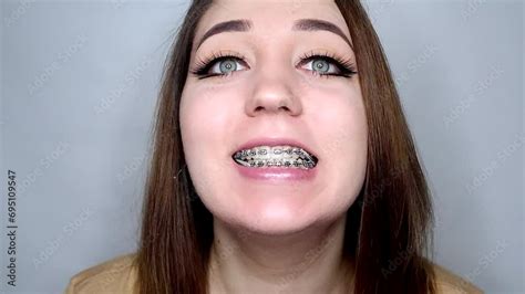 Elastics Installed On Braces Close Up Beautiful Woman Points With Finger At New Elastics