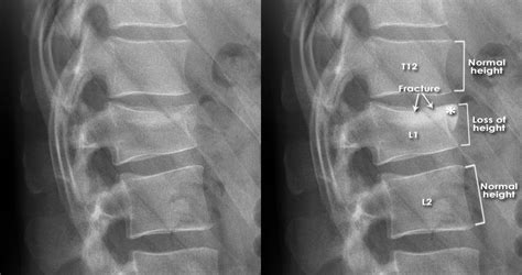 Compression Fracture