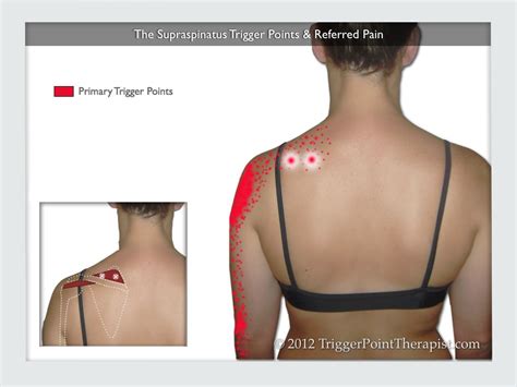 Supraspinatus Trigger Points Treating The Stubborn Atus TriggerPointTherapist Com