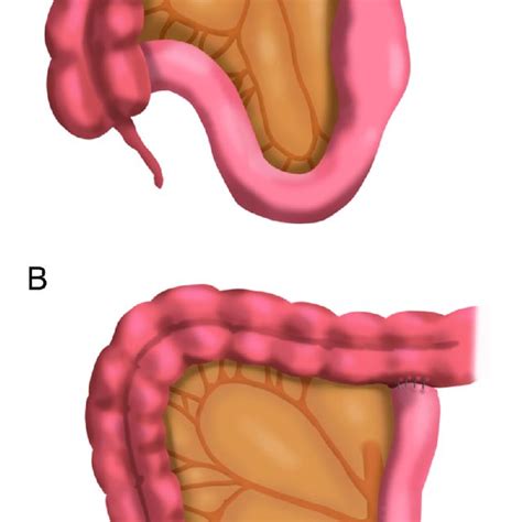 Bypass Surgery Simples Bypass A And Exclusion Bypass B Download Scientific Diagram