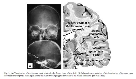 Bódizs R Sverteczki M Lázár As Halász P Human Parahippocampal Activity Non Rem And Rem