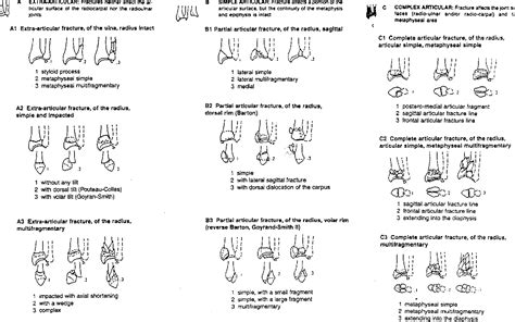 Distal Radius Fracture Classification Denevent