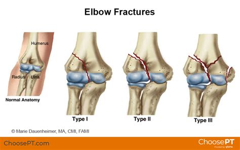 Did I Fracture My Elbow Doctorvisit