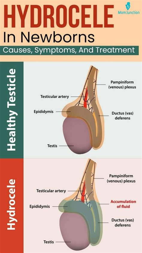 Hemolytic Disease Of The Newborn Hdn Causes And Treatment Artofit