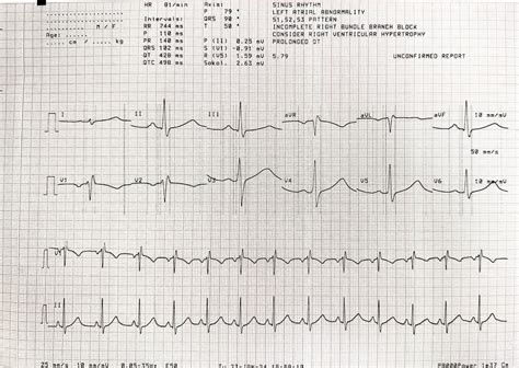 39m Long Qt Routine Ecg In December Showed A Qtc Of 458ms Now Up To 490ms Historically