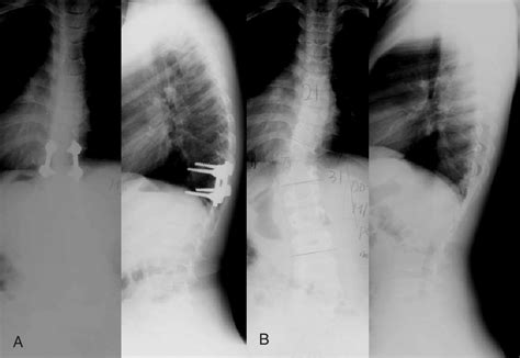 A Radiographs Taken Before Implant Removal Showing That The Main Download Scientific Diagram