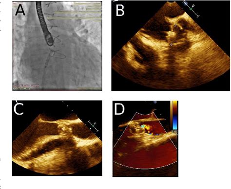 Figure 1 From The Value Of 3d Printing For Laao Device Sizing Semantic Scholar