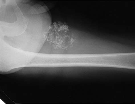 Figure 1 Extraskeletal Osteosarcoma With Partial Spontaneous Regression Anticancer Research