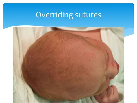 Ppt Normal Newborn Care Powerpoint Presentation Free Download Id 2313221