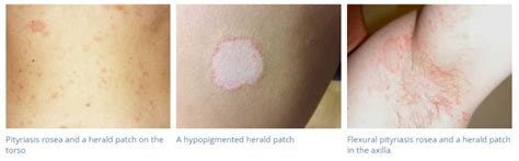 장미색 비강진 Pityriasis Rosea 원인 증상 진단 치료 네이버 블로그