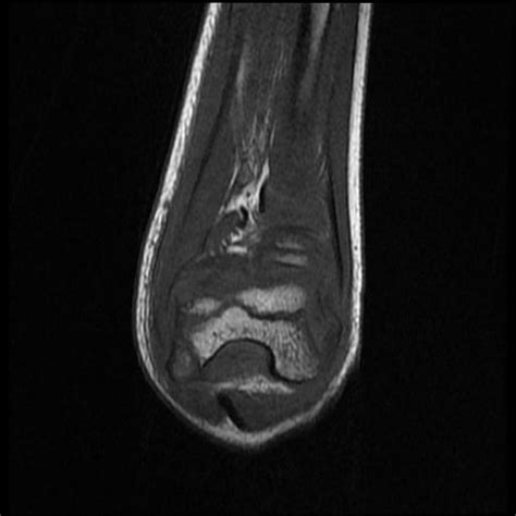 Olecranon Fracture Image Radiopaediaorg Olecranon Fractures