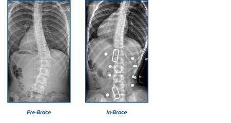 Night Brace Case Studies The Ultimate Custom Made 3d Correction System