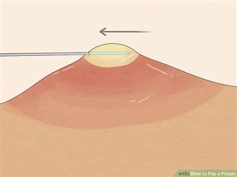 Simple Ways To Pop A Pimple WikiHow