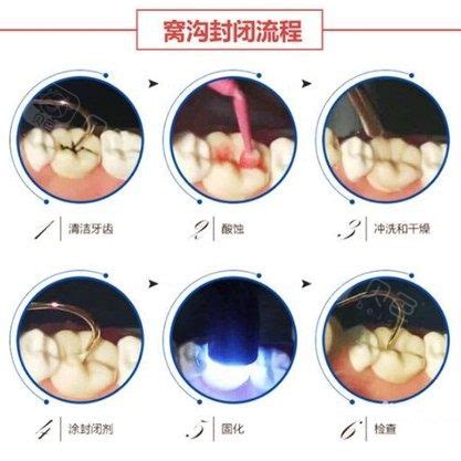 窝沟封闭 人民广场 德恩口腔 儿童窝沟封闭1颗节假日通用免费停车位 襄阳德恩口腔机构 贝色口腔