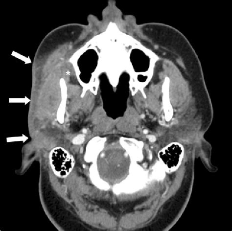 Figure 1 From Ct Imaging Of Head And Neck Lupus Panniculitis Semantic