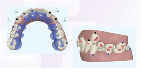 Clear Aligners In Phase 1 Treatment By Dr Donna Galante Orthotown