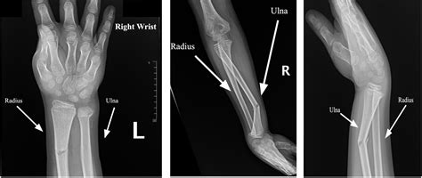 Comminuted Displaced And Angulated Distal Radial And Ulnar Metaphyseal Fractures After A