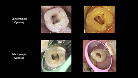 Microscopic Root Canal Treatment In Chennai Access Dental