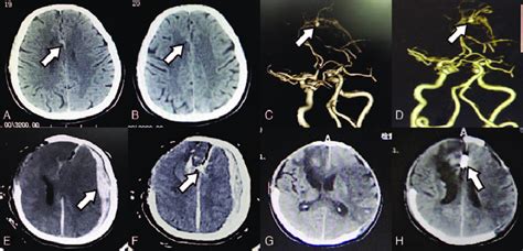 Radiological Profiles Of Case 2 A B Ct Revealed Hyperintensity