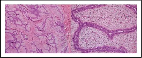 Benign Phyllodes Tumor Semantic Scholar