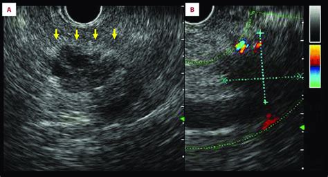 Findings On Endoscopic Ultrasonography The Low Echoic And Diffuse Download Scientific Diagram