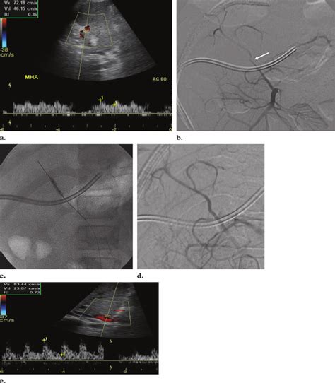 Hepatic Artery Stenosis In A 13 Year Old Patient After Split Liver
