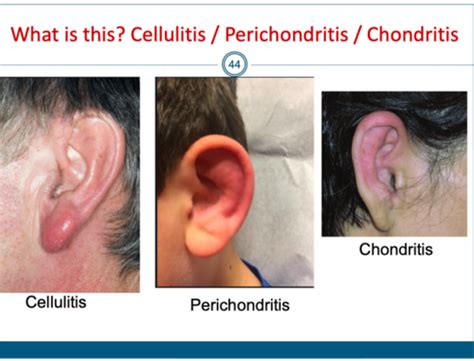 Ent Exam Flashcards Quizlet