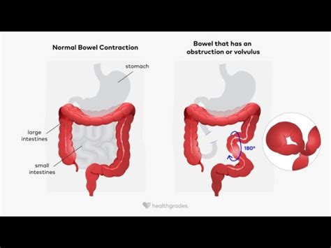 Volvulus Symptoms