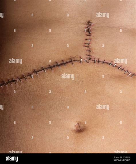 Closeup Of Medical Staples Helping A Surgical Incision And Scar Heal