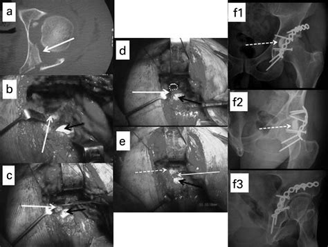 Acetabular Fractures With Marginal Impaction Bone And Joint