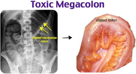 Toxic Megacolon C Diff