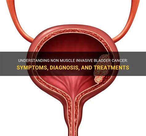 Understanding Non Muscle Invasive Bladder Cancer Symptoms Diagnosis And Treatments Medshun