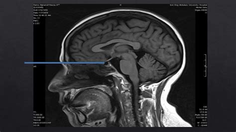 Cerebral Cisterns For Radiology Dnb Pptx