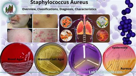 Staphylococcus Aureus Overview Symptoms Causes 59 Off