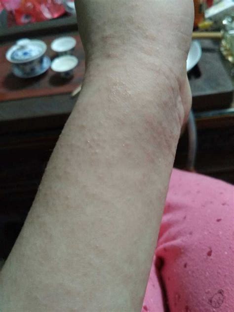 过敏性湿疹皮炎图片有来医生