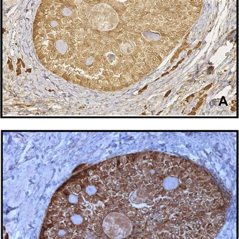 Pdf Non Syndromic Bilateral Ovarian Sex Cord Stromal Tumor With Annular Tubules In A